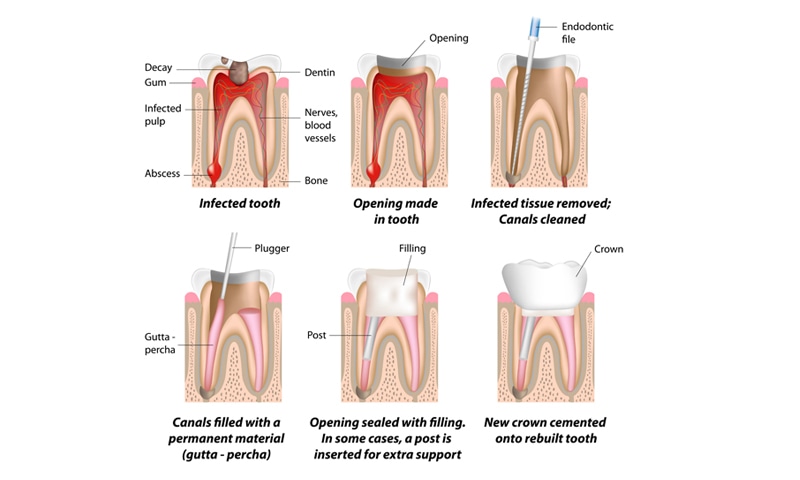 Root Canal Therapy | Toukley Dentists